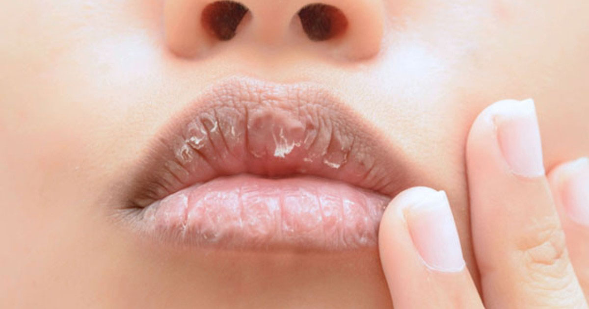 Qué Enfermedades Resecan Los Labios Elidebio